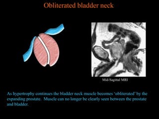 Prostate MRI anatomy from UNIVERSITY OF MICHIGAN | PPTX