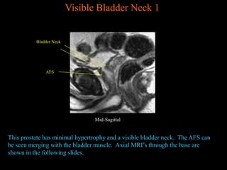 Prostate MRI anatomy from UNIVERSITY OF MICHIGAN | PPTX