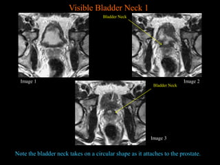 Prostate MRI anatomy from UNIVERSITY OF MICHIGAN | PPTX