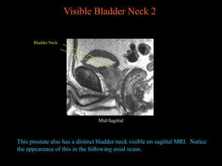 Prostate MRI anatomy from UNIVERSITY OF MICHIGAN | PPTX