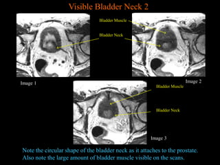 Prostate MRI anatomy from UNIVERSITY OF MICHIGAN | PPTX