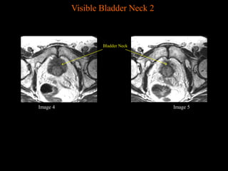 Prostate MRI anatomy from UNIVERSITY OF MICHIGAN | PPTX