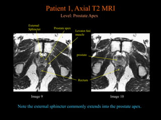 Prostate MRI anatomy from UNIVERSITY OF MICHIGAN | PPT