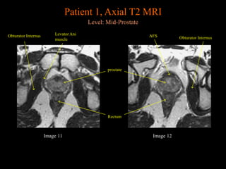 Obturator Internus Mri