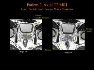 Prostate MRI anatomy from UNIVERSITY OF MICHIGAN | PPT