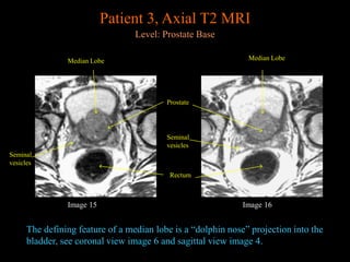 Prostate Anatomy Mri