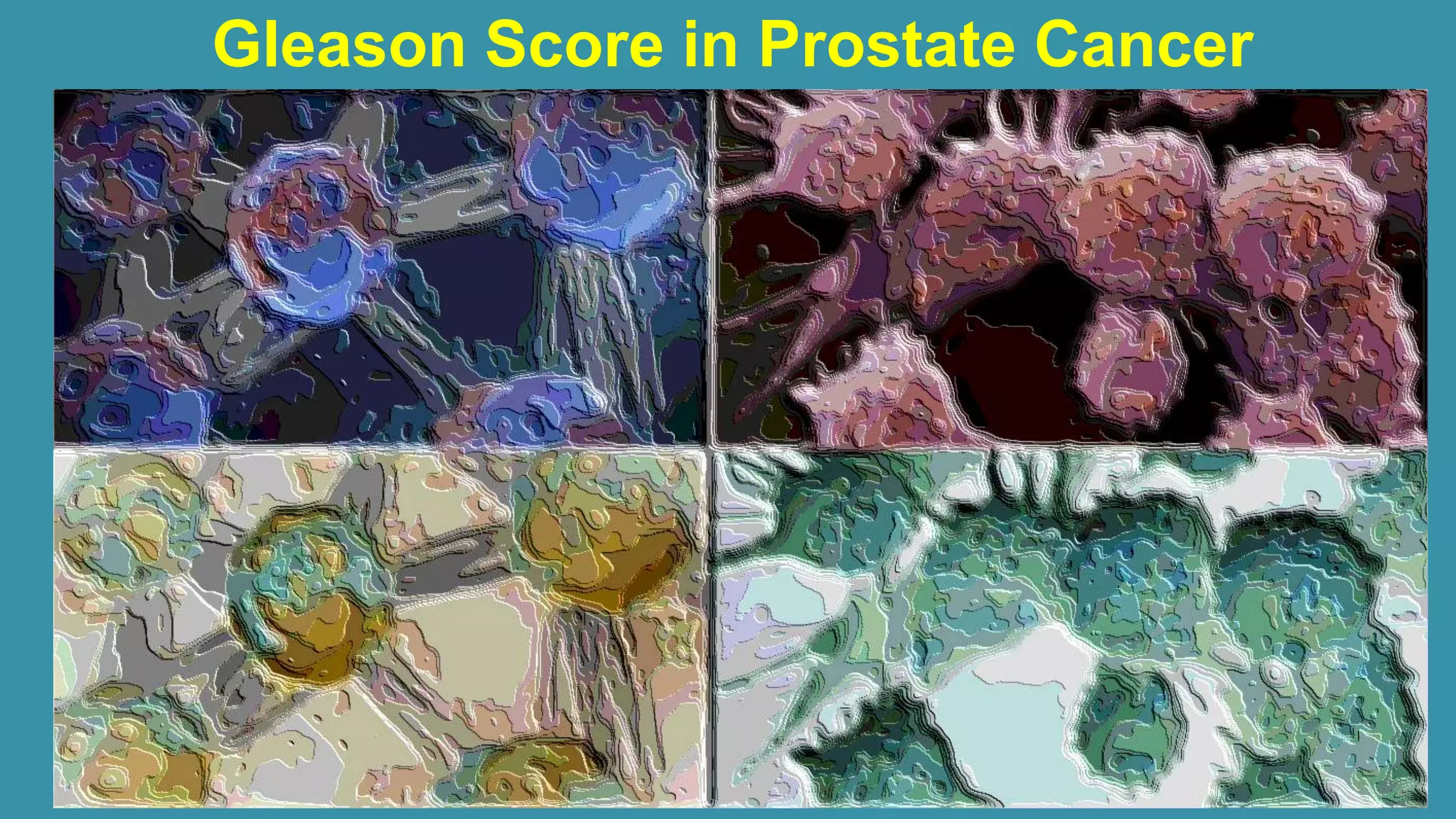 Prostate Cancer and Gleason Score | PPTX