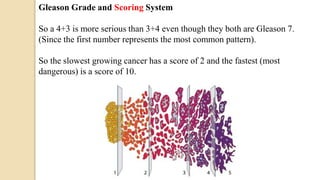 Prostate Cancer and Gleason Score | PPTX