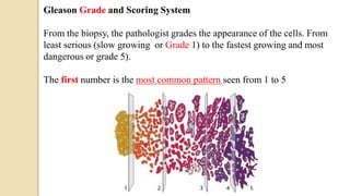Prostate Cancer and Gleason Score | PPTX