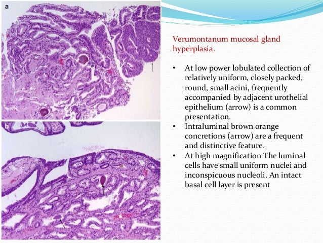 Prostate biopsy