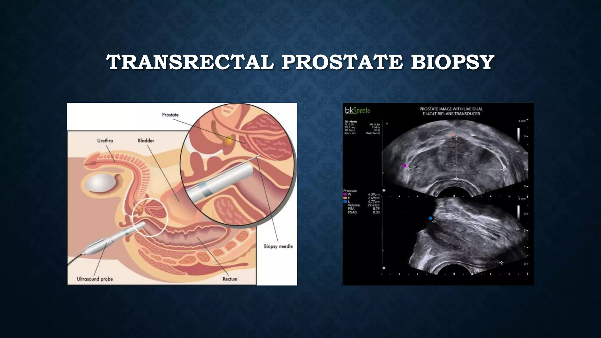 Prostate Biopsy.pptx