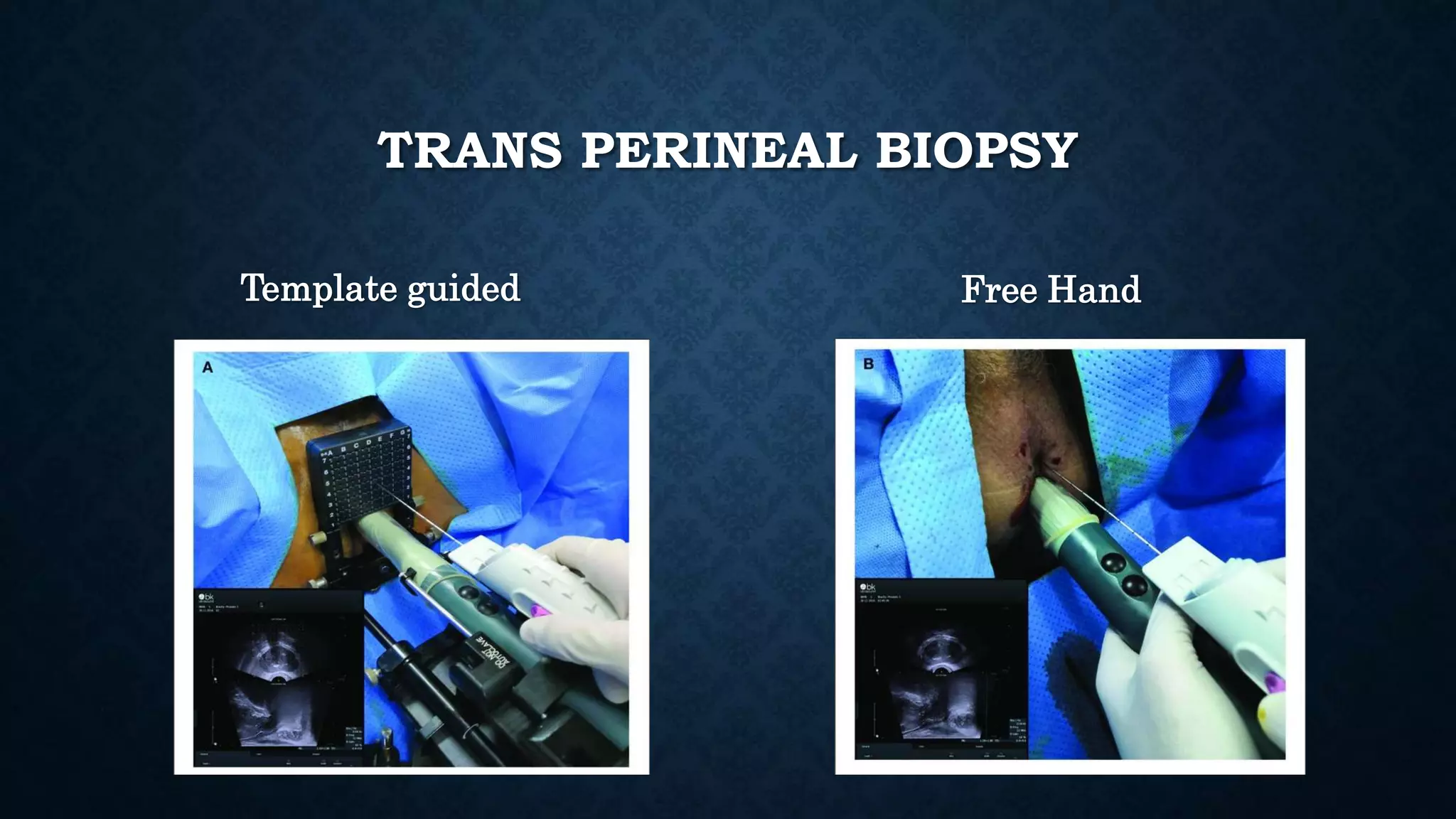 Prostate Biopsy.pptx