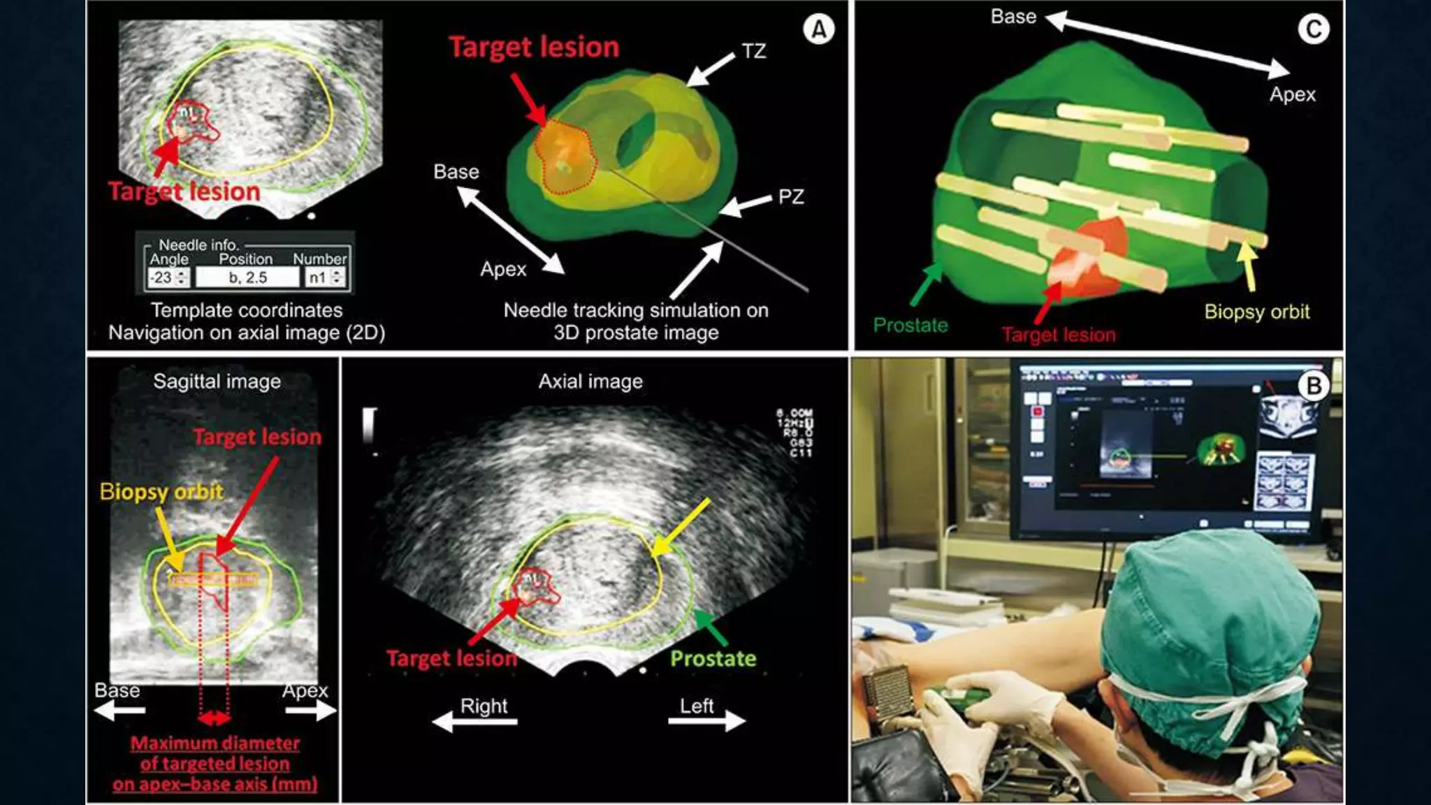 Prostate Biopsy.pptx