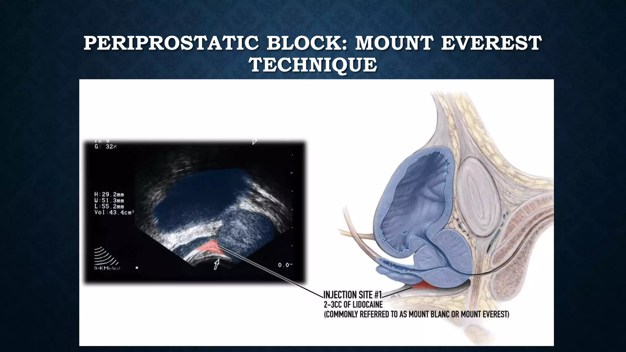 Prostate Biopsy.pptx