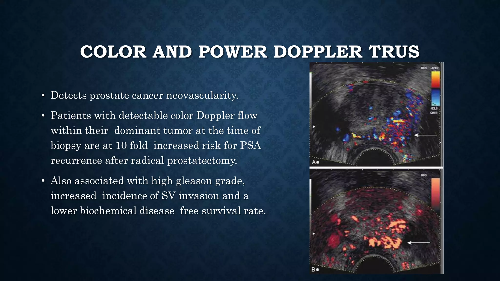 Prostate Biopsy.pptx