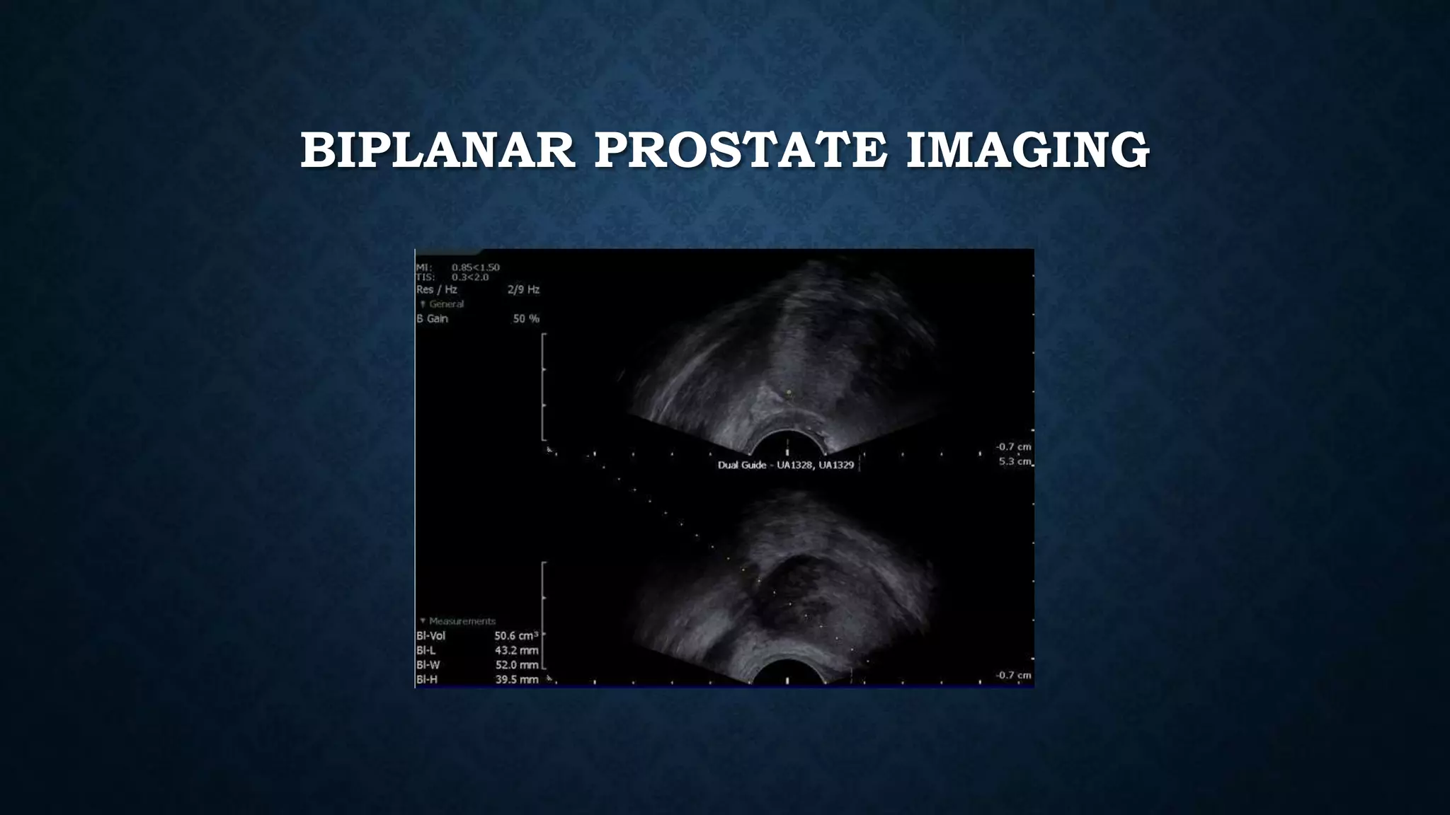 Prostate Biopsy.pptx