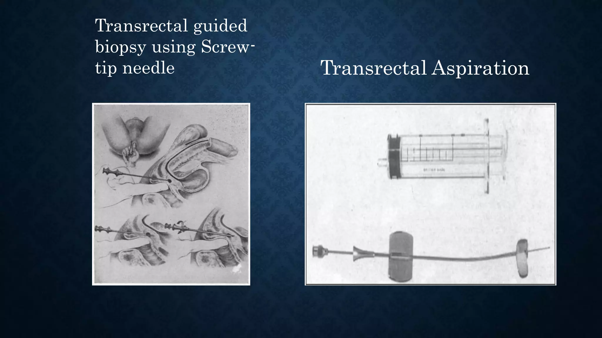 Prostate Biopsy.pptx