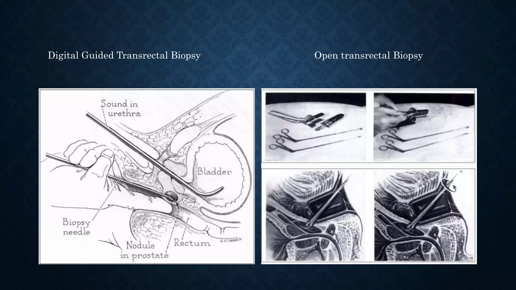 Prostate Biopsy.pptx