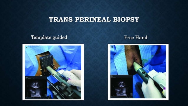 Prostate Biopsy.pptx | Physical Therapy | Wellness