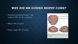 Prostate Biopsy.pptx