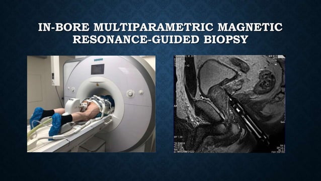Prostate Biopsy.pptx | Physical Therapy | Wellness