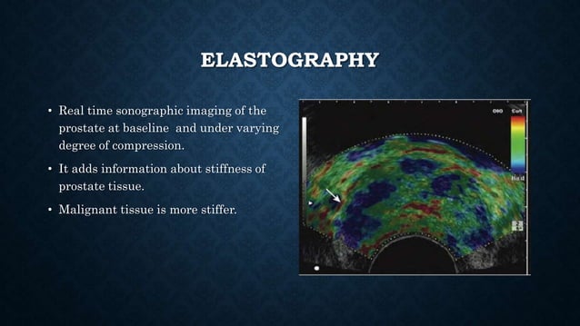 Prostate Biopsy.pptx | Physical Therapy | Wellness