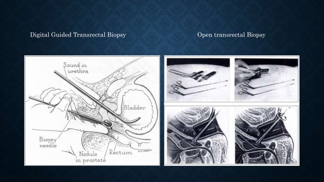 Prostate Biopsy.pptx | Physical Therapy | Wellness