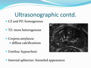 Prostate Biopsy (PBx).pptx
