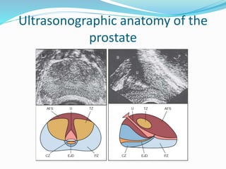 Prostate Biopsy (PBx).pptx