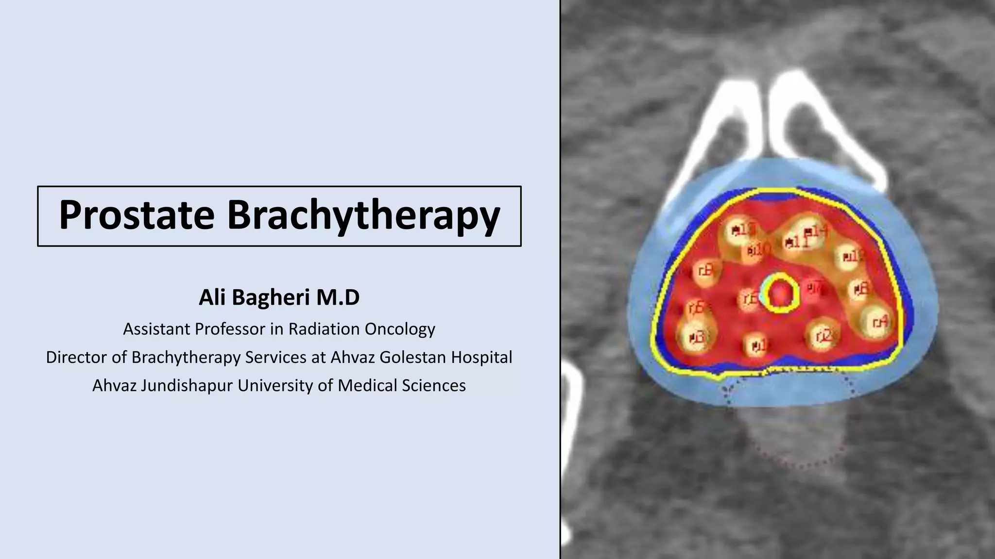 Prostate Brachytherapy Ppt