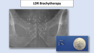 Prostate Brachytherapy | PPTX