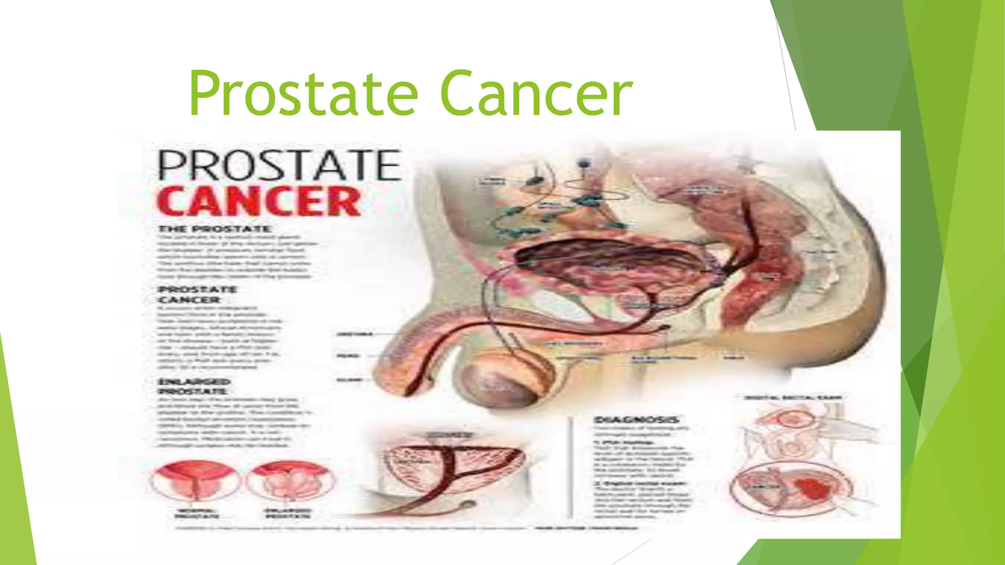 Prostate cancer | PPTX