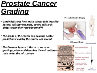 Prostate cancer | PPT