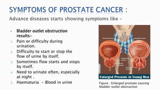 Prostate cancer | PPTX