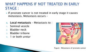 Prostate cancer | PPTX