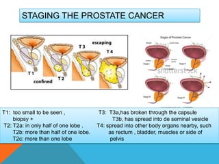 Prostate cancer - Vincent Batista Lemaire | PPT