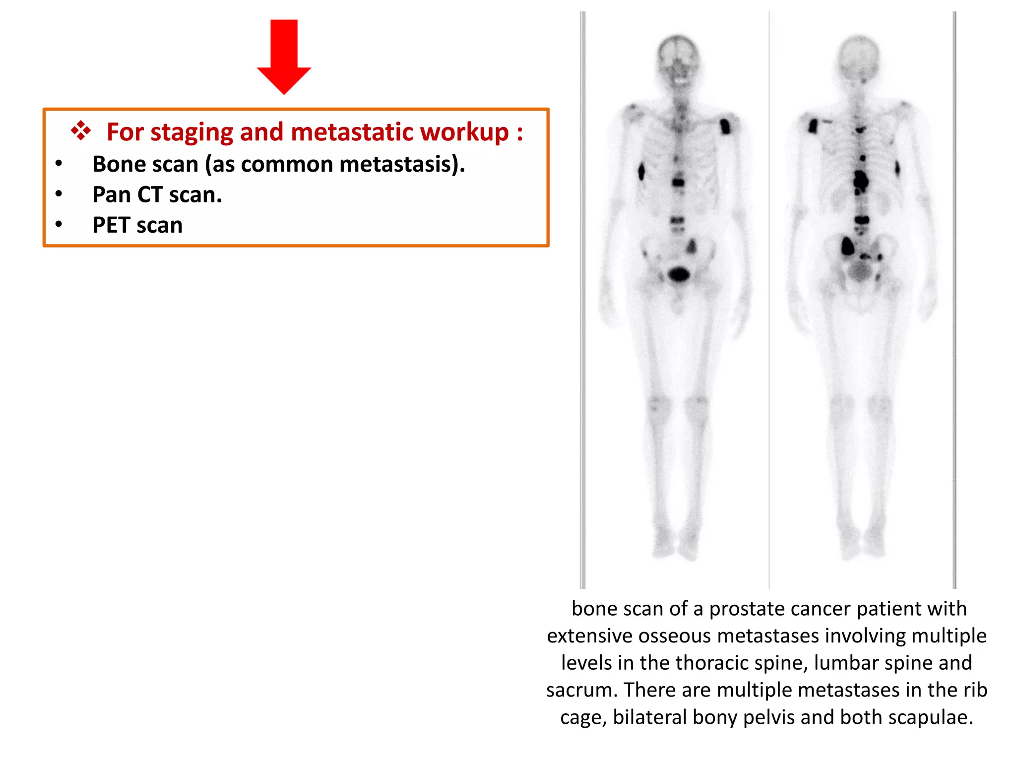 Prostate cancer | PPTX