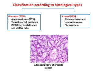 Prostate cancer | PPTX