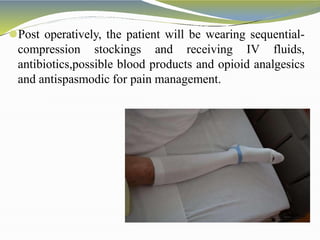 prostatecancer-200417071749.pptx