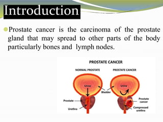 prostatecancer-200417071749.pptx