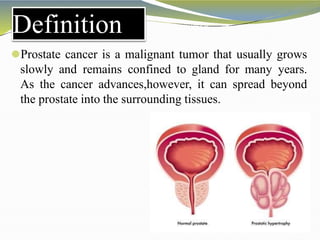 prostatecancer-200417071749.pptx