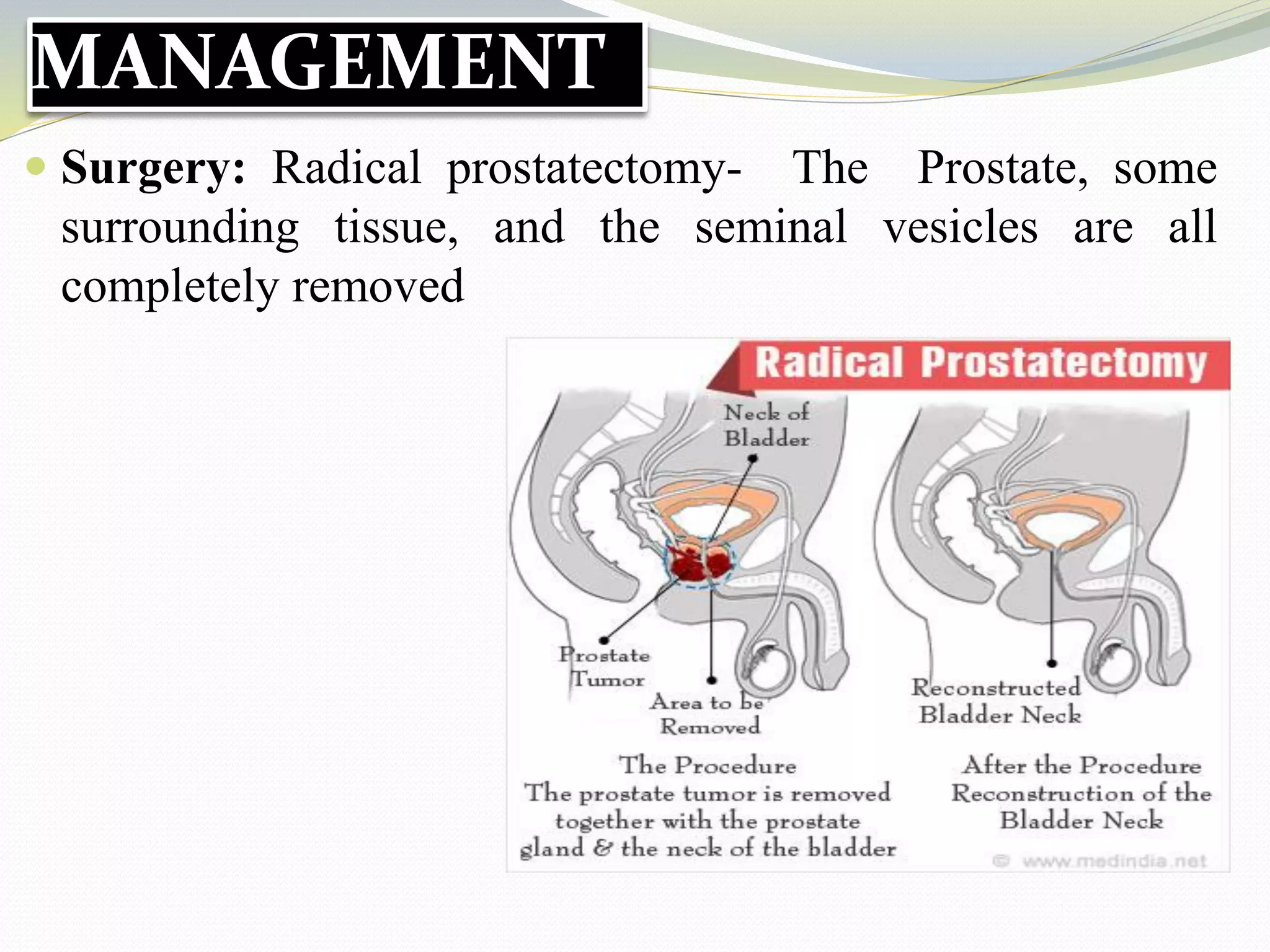 Prostate Cancer Carcinoma Of The Prostate Presented By Mr Bkalyan Kumar Msc N Dept Of Msn