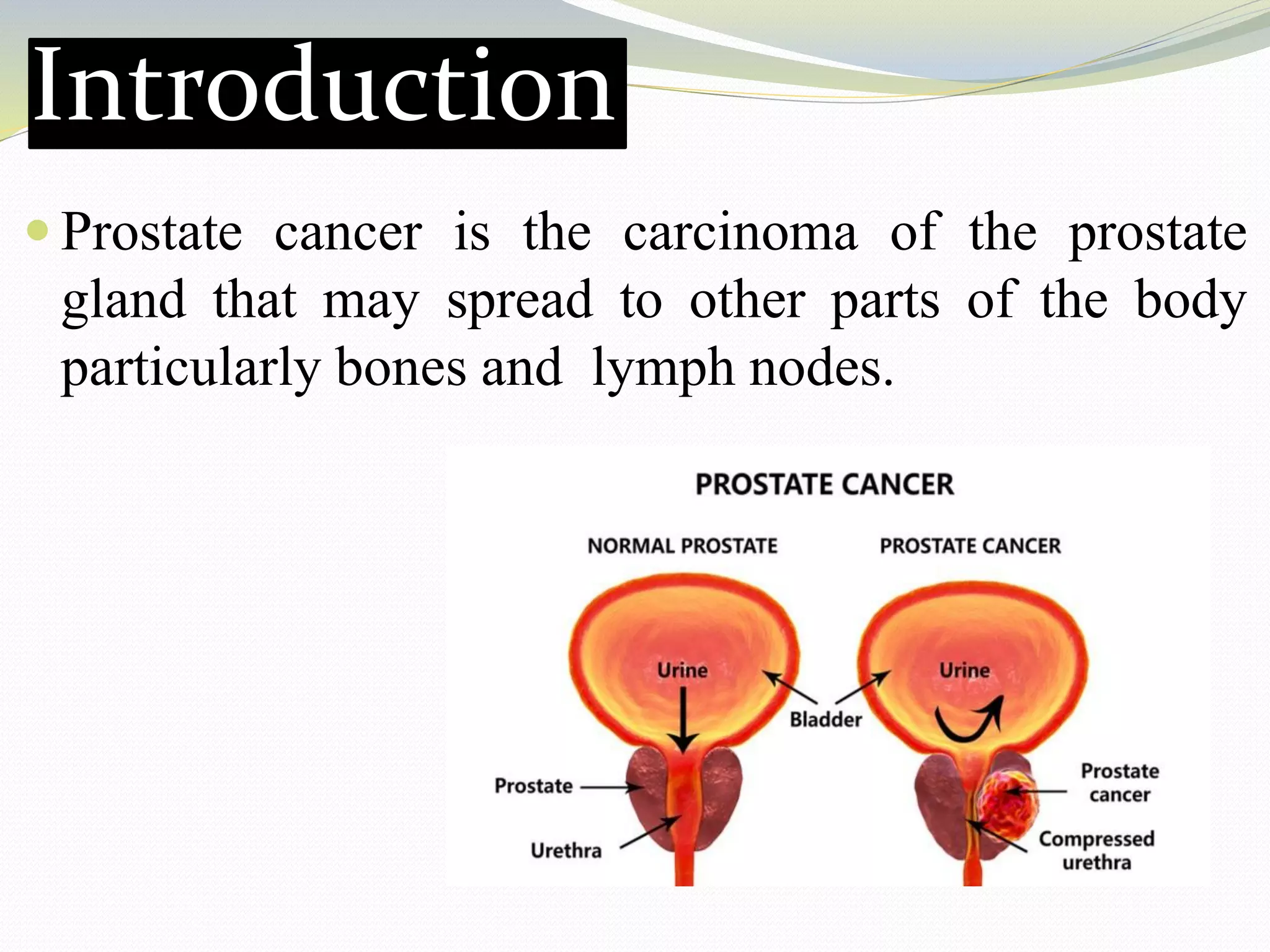 Prostate Cancer Carcinoma Of The Prostate Presented By Mr Bkalyan Kumar Msc N Dept Of Msn