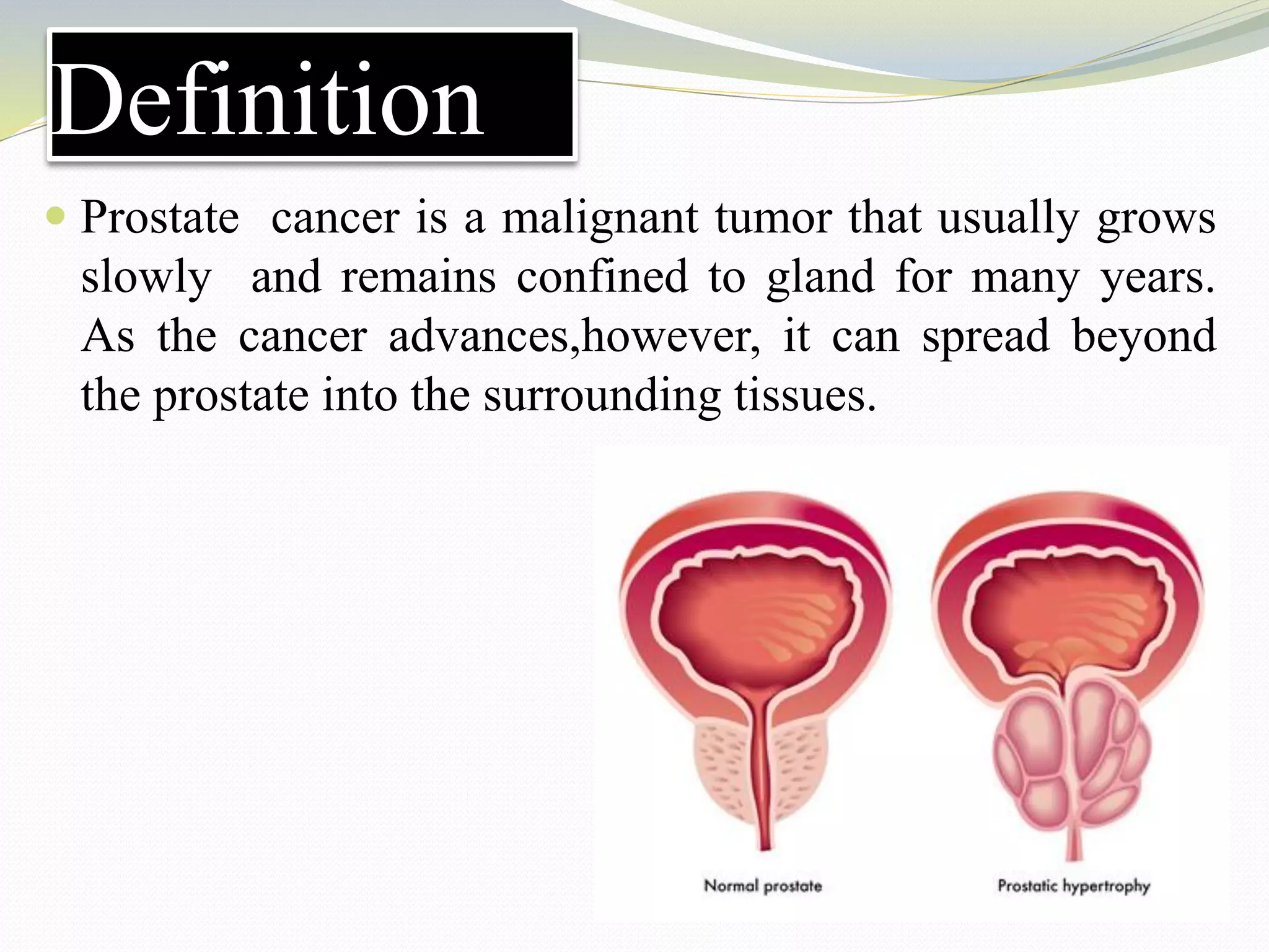 Prostate Cancer Carcinoma Of The Prostate Presented By Mr Bkalyan Kumar Msc N Dept Of Msn