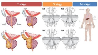 Prostate cancer | PDF