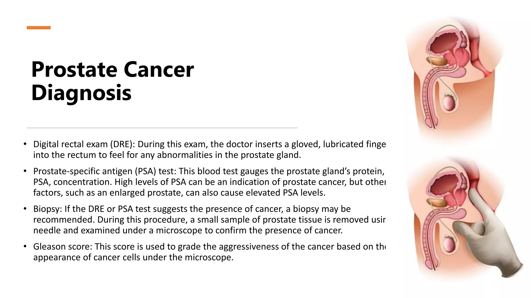 Prostate Cancer.pptx