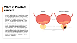 Prostate Cancer.pptx