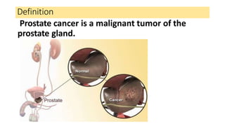 Prostate cancer | PPTX | Sexual Conditions | Sexual Health