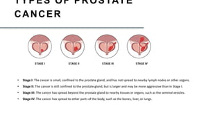 Prostate Cancer: Understanding The Basics And Facts You Need To Know | PPT