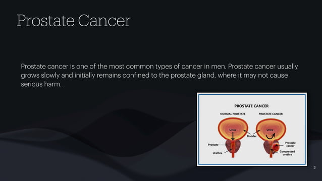 prostate cancer defention ,diagnosis,treatment | PPT